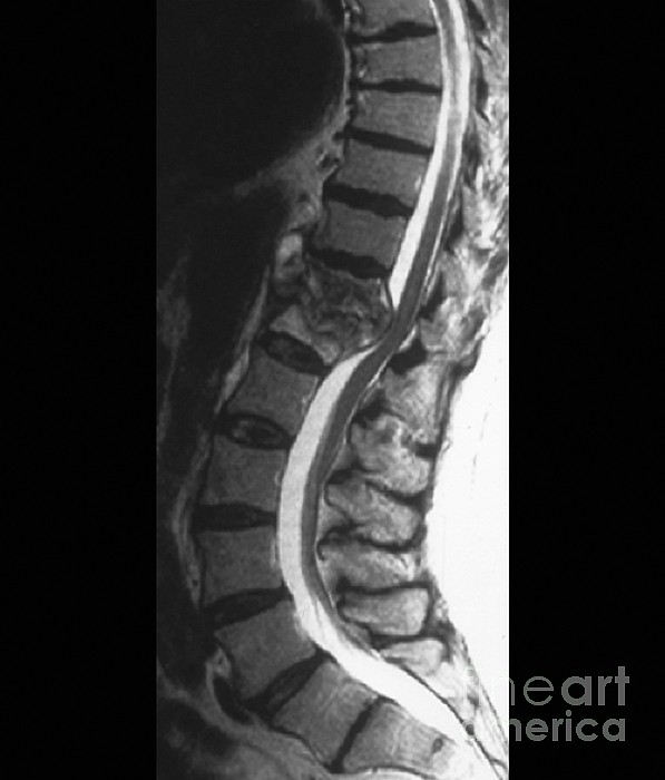 Tuberculosis Of The Spine Mri Scan By Zephyr