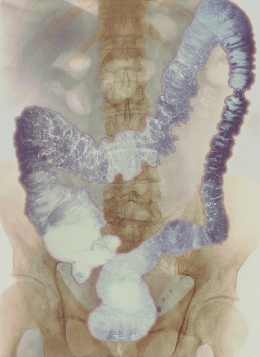 Ulcerative Colitis X-ray #2 Greeting Card by Cnri / Science Photo Library
