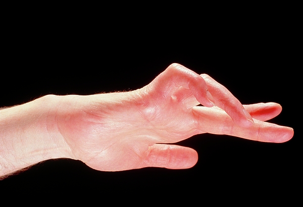 Claw-hand Due To Trapped Ulnar Nerve Greeting Card by Medical Photo Nhs ...