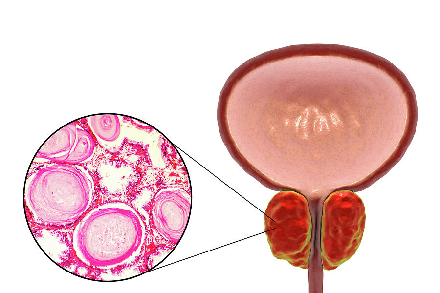 Benign Prostatic Hyperplasia Photograph By Kateryna Kon Science Photo