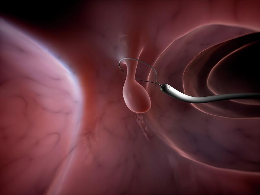 Colon Polyp 1 By Sciepro Science Photo Library