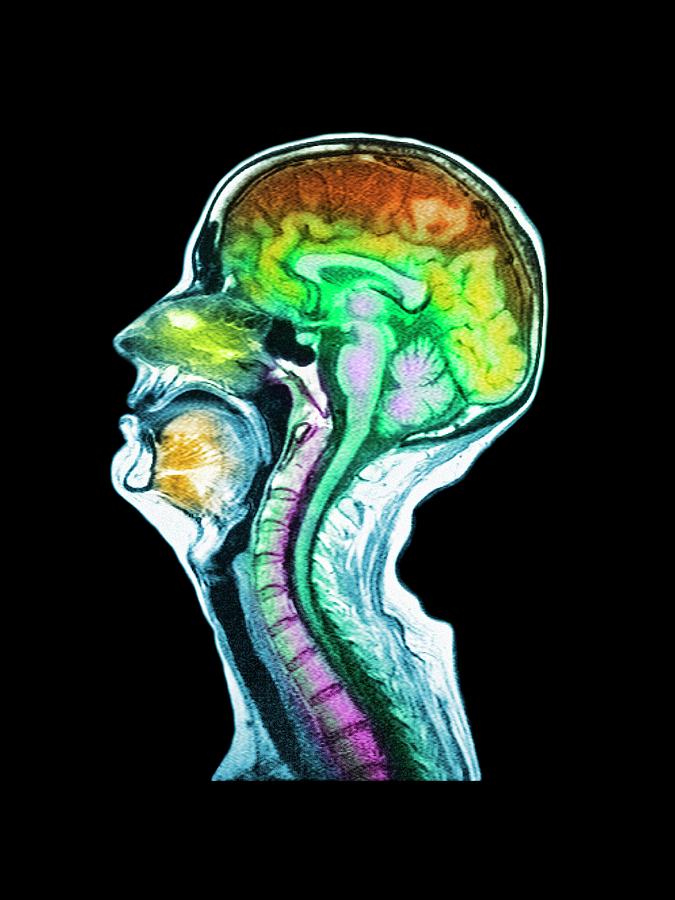 Coloured Mri Scan Of A Brain With Cerebral Atrophy Photograph by Simon Fraser/royal Victoria ...