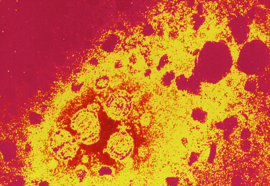 Coloured Tem Of Hepatitis B Virus Particles Photograph By Cdc Science