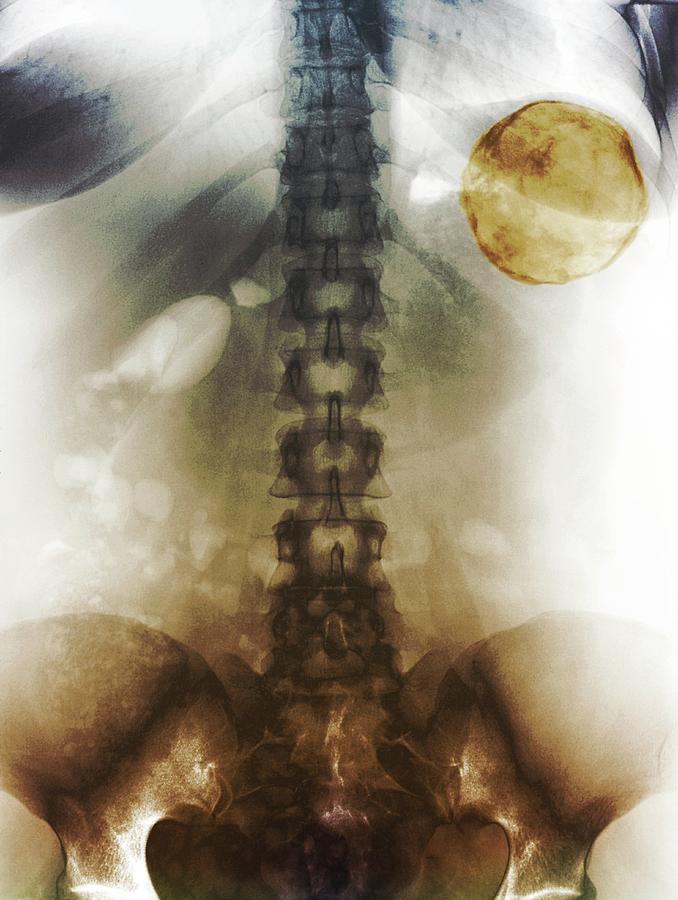 Cyst Of The Spleen Photograph By Zephyrscience Photo Library Pixels