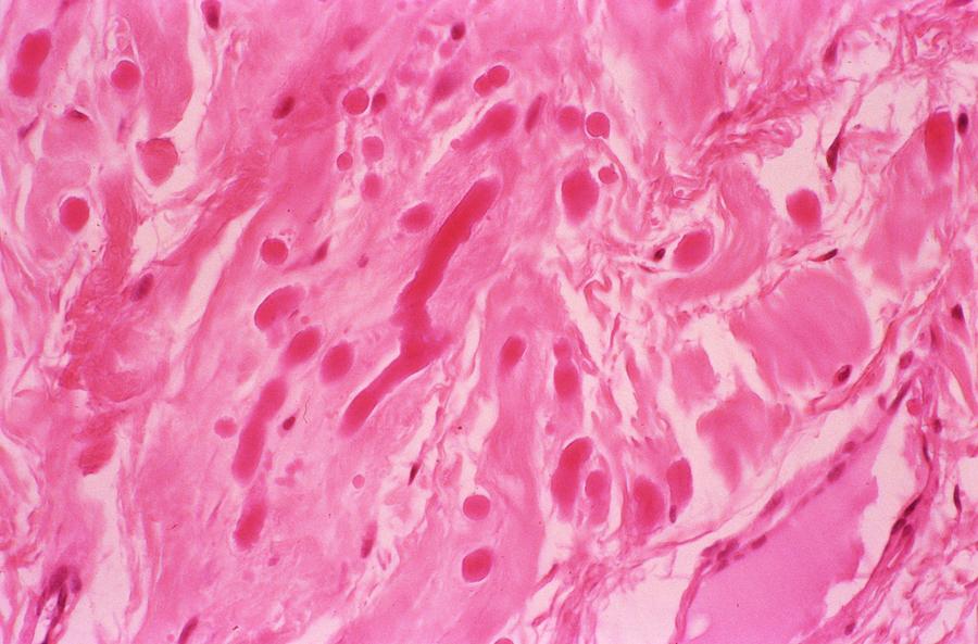 Elastofibroma Photograph by Cnri/science Photo Library - Fine Art America