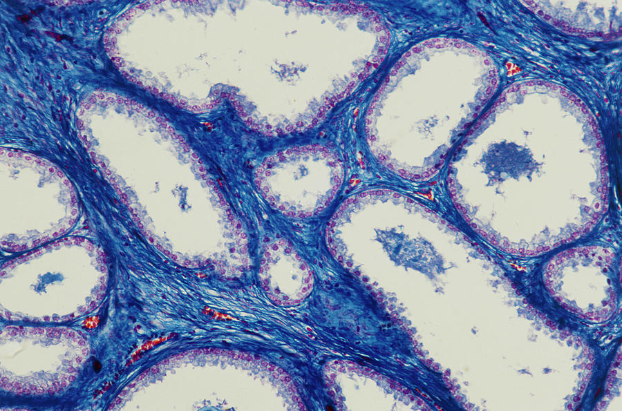 Lm Of Prostate Gland Hypertrophy (enlargement) Photograph by Astrid & Hanns-frieder Michler ...
