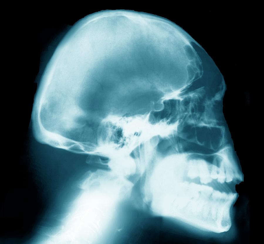 Microcephaly #1 by Science Photo Library