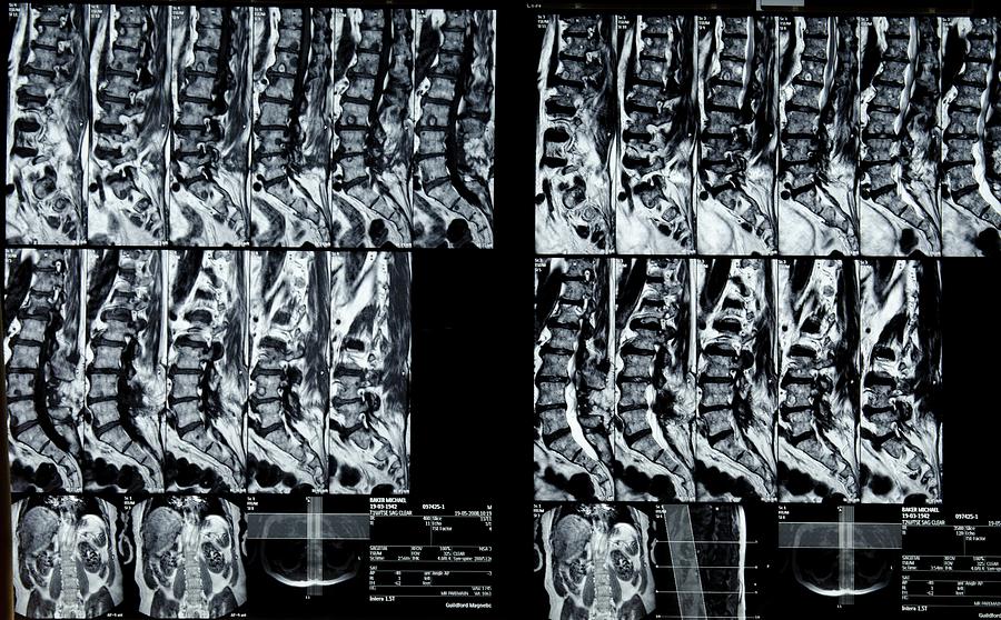Mri Scans Of The Spine Photograph by Dr P. Marazzi/science Photo Library