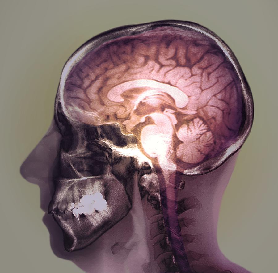 Normal Brain Photograph by Zephyr/science Photo Library - Fine Art America