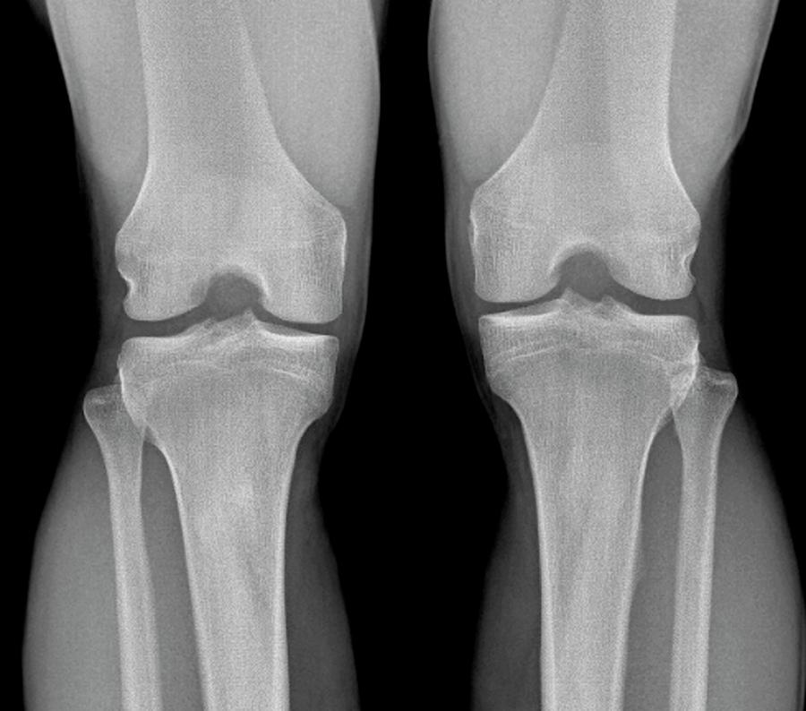 Normal Knees #1 by Science Photo Library