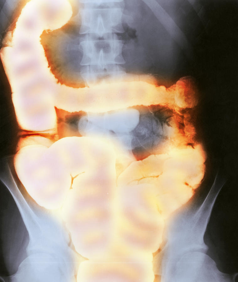 Spinal Cord, Ulcerative Colitis, X-ray Photograph by Science Source ...