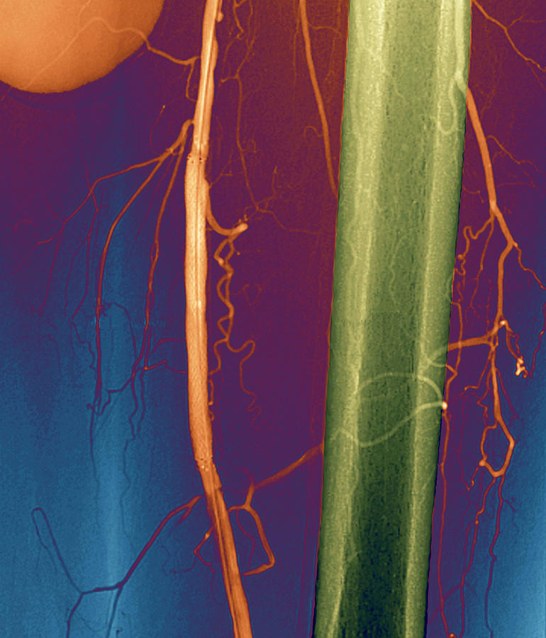 Stent In A Femoral Artery #1 Photograph by Science Photo Library - Fine Art America