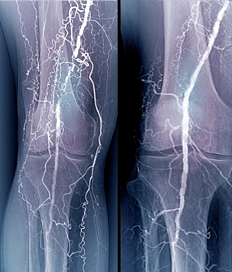 Treatment For Blocked Femoral Artery Photograph by Zephyr/science Photo Library - Pixels