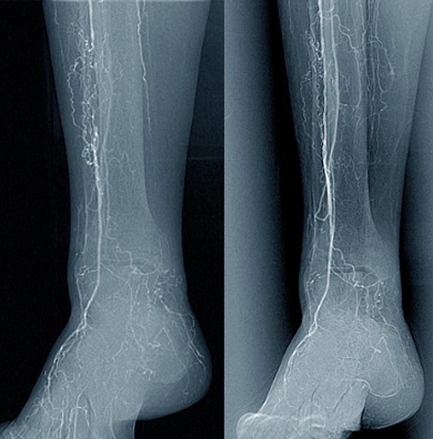 Treatment For Blocked Leg Arteries Photograph By Zephyrscience Photo Library Pixels