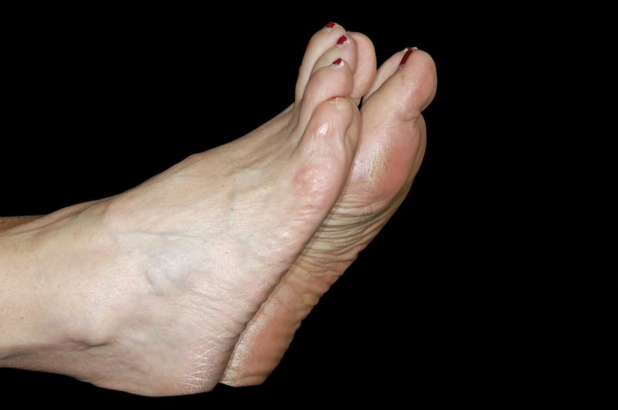 Unequal Leg Length Photograph by Dr P. Marazzi/science Photo Library