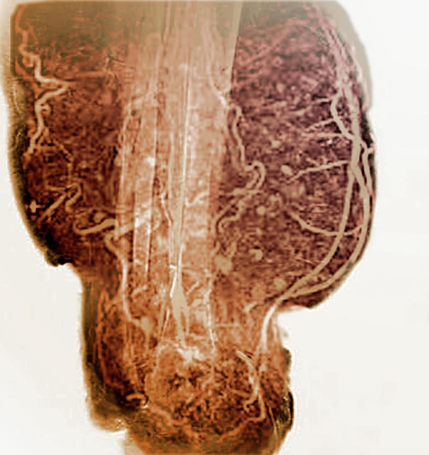 Elephantiasis Images