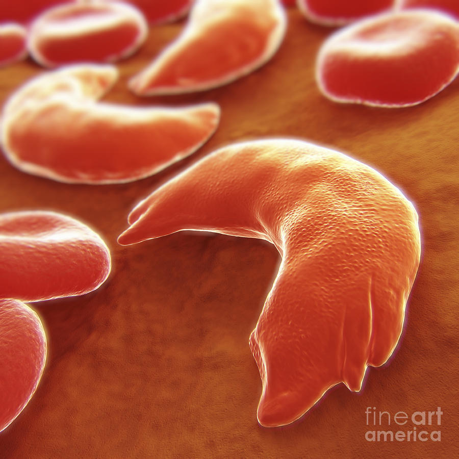 Sickle-cell Disease Photograph by Science Picture Co - Pixels