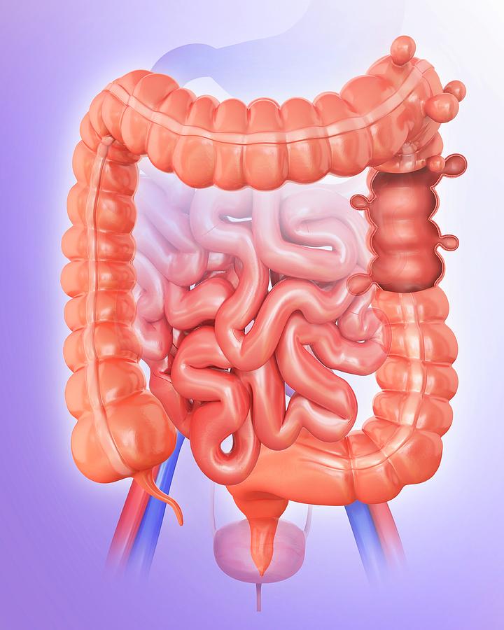 Diverticulitis Photograph by Pixologicstudio - Pixels