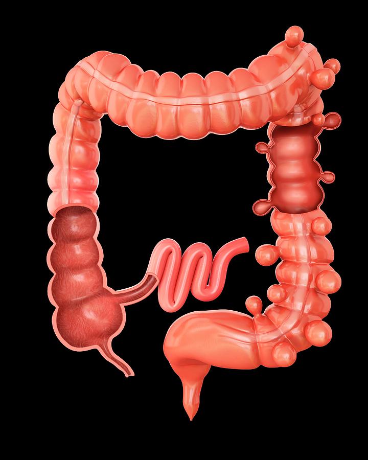 Diverticulitis Photograph by Pixologicstudio - Fine Art America