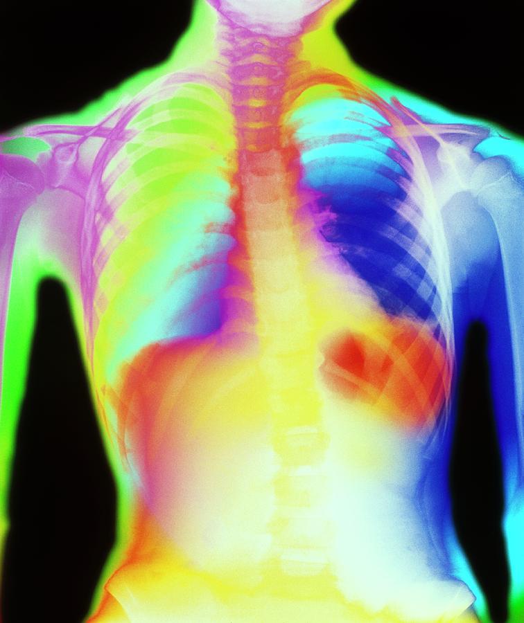 Coloured Chest X-ray Showing Pneumonia Photograph by Mehau Kulyk ...