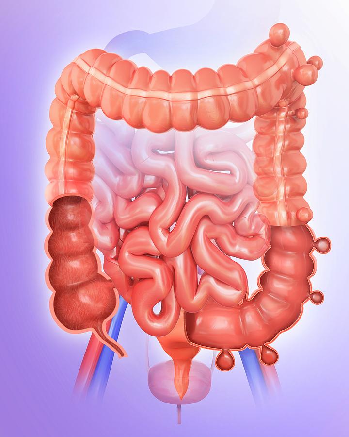 Diverticulitis Photograph By Pixologicstudio Fine Art America