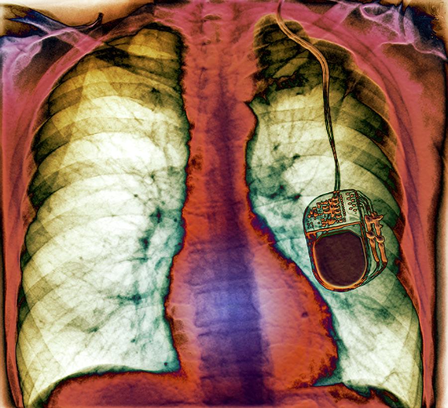 Parkinson's Brain Pacemaker #4 by Science Photo Library