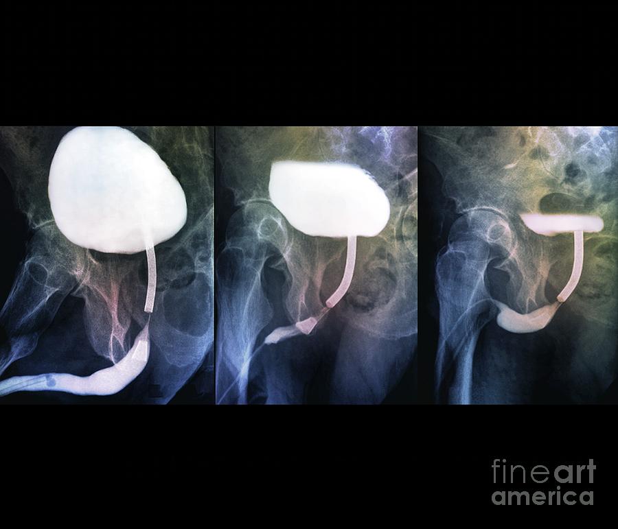 Voiding Cystourethrogram, X-rays Photograph by Zephyr - Fine Art America