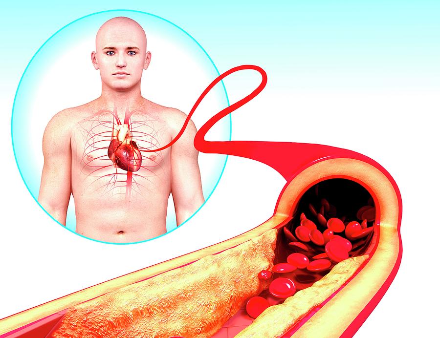 Atherosclerosis #48 by Science Photo Library