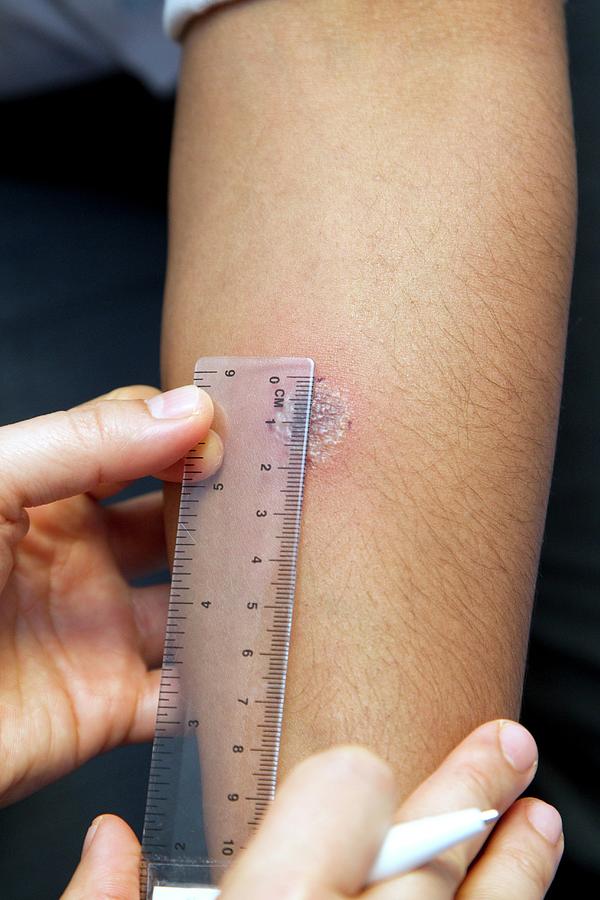 Tuberculosis Testing Photograph by Mark Thomas/science Photo Library ...