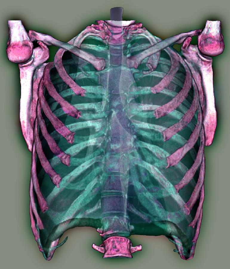 Pneumothorax #7 by Science Photo Library