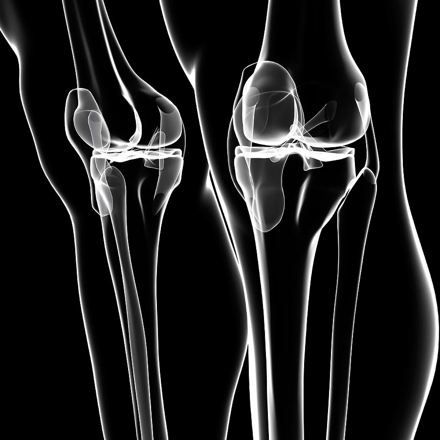 Human Leg Bones Photograph by Pixologicstudio/science Photo Library ...