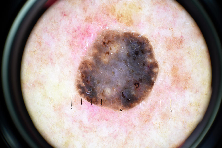 Seborrheic Keratosis Photograph By Dr P Marazzi Science Photo Library