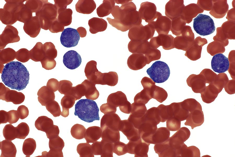 Acute Monocytic Leukaemia by Science Photo Library