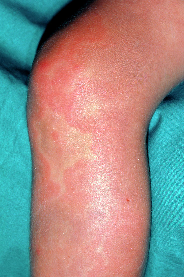 Allergic Urticaria On Leg Photograph By Dr P Marazzi Science Photo Library