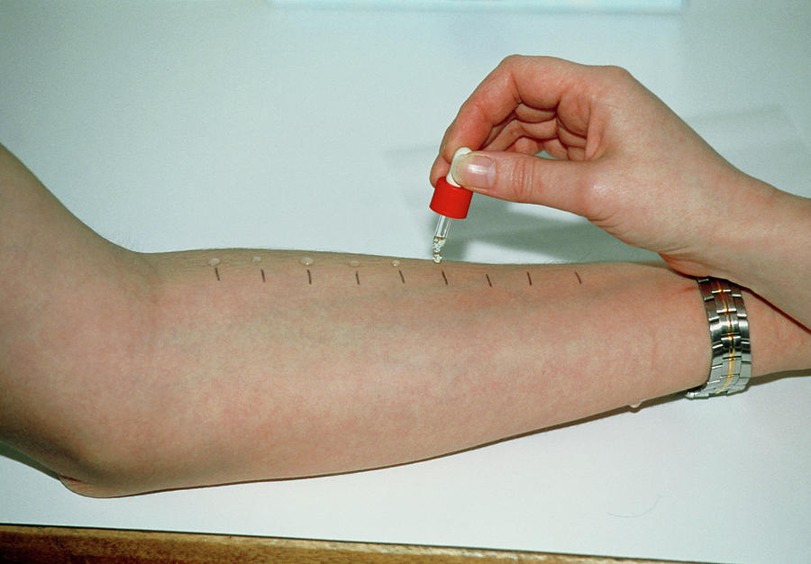 Allergy Test Photograph By Dr P Marazzi Science Photo Library