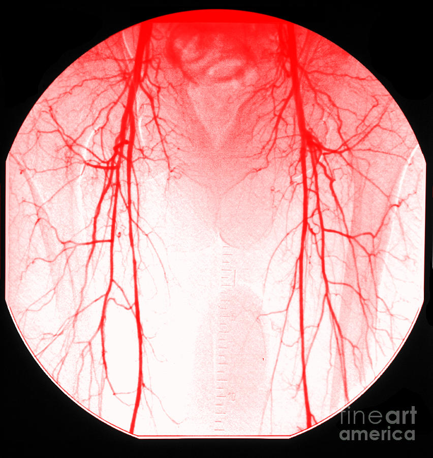 Aortic Angiogram Photograph by Scott Camazine - Pixels
