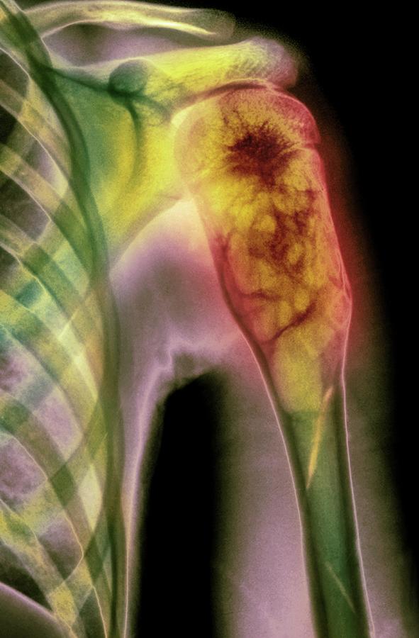 Benign Bone Cyst Photograph by Mike Devlin - Fine Art America