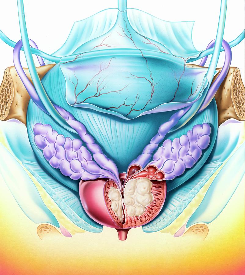 Benign Prostatatic Hyperplasia Photograph By John Bavosi