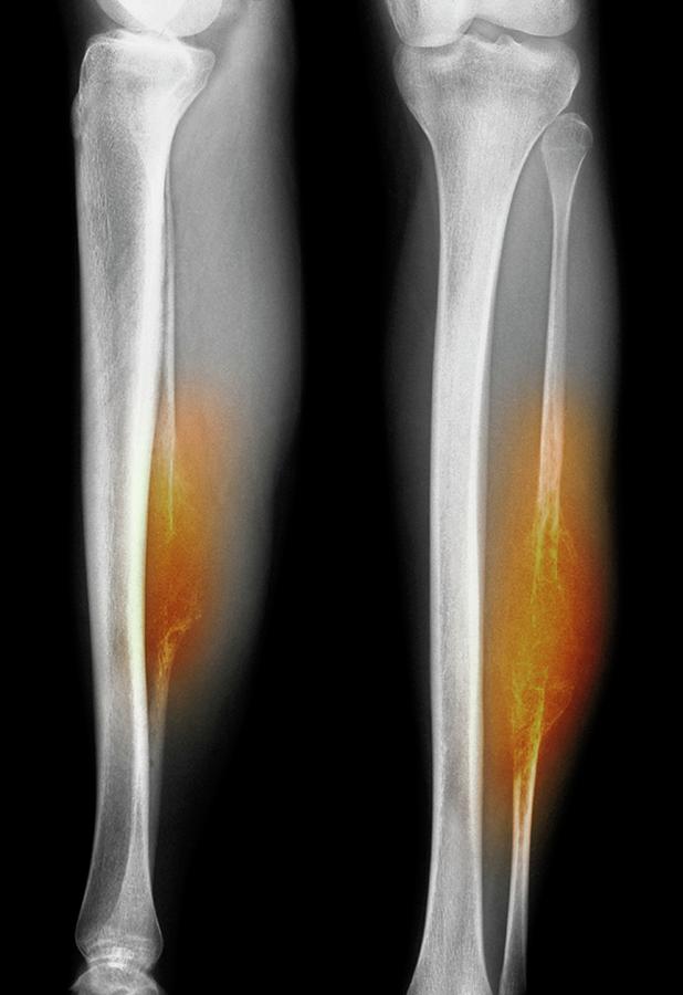 Bone Tumour by Science Photo Library