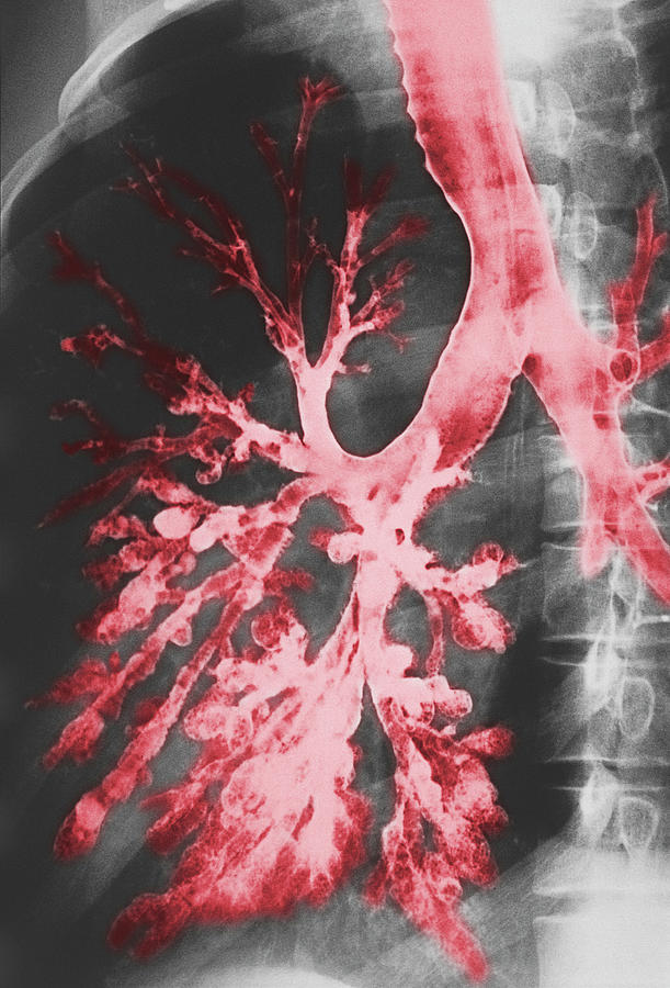 Bronchiectasis Photograph by Gjlp/science Photo Library - Pixels