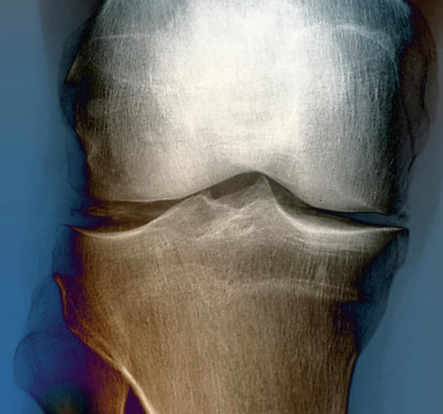 Calcification In The Knee by Science Photo Library