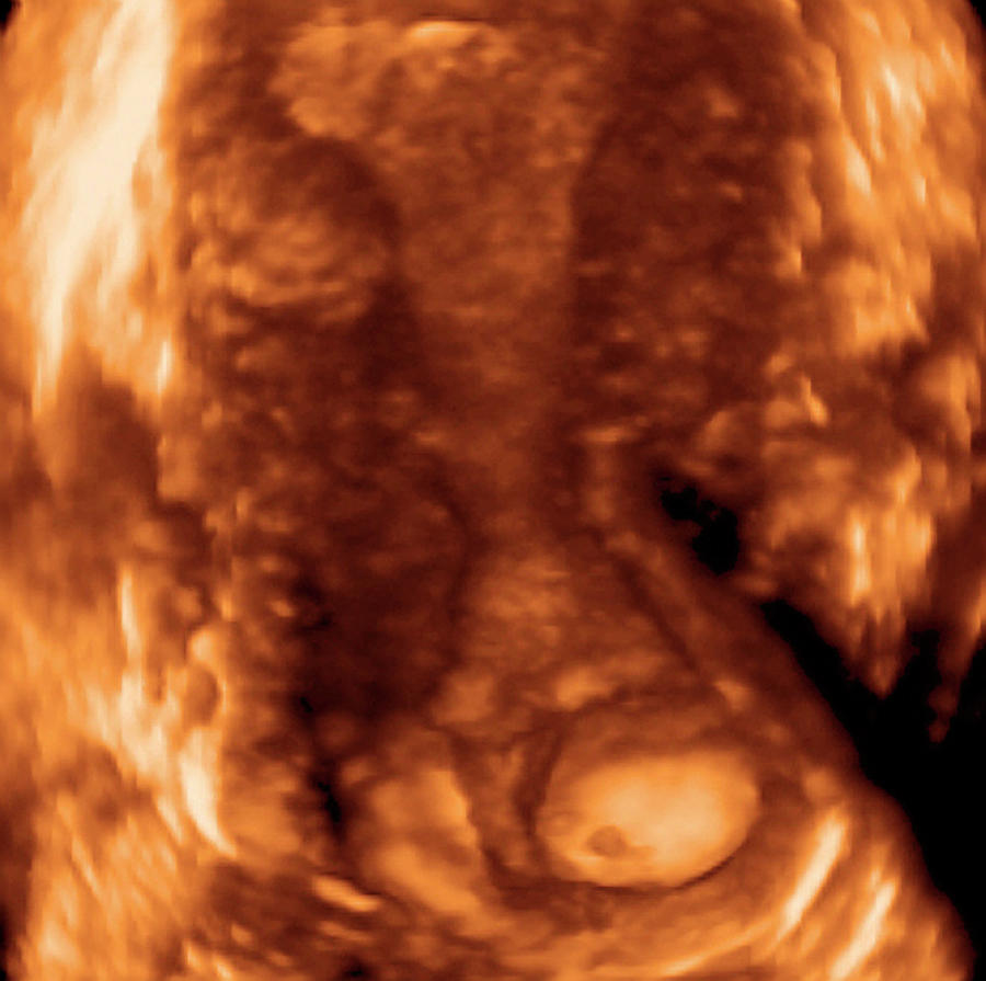 Cervical Cyst Photograph By Dr Najeeb Layyousscience Photo Library Pixels