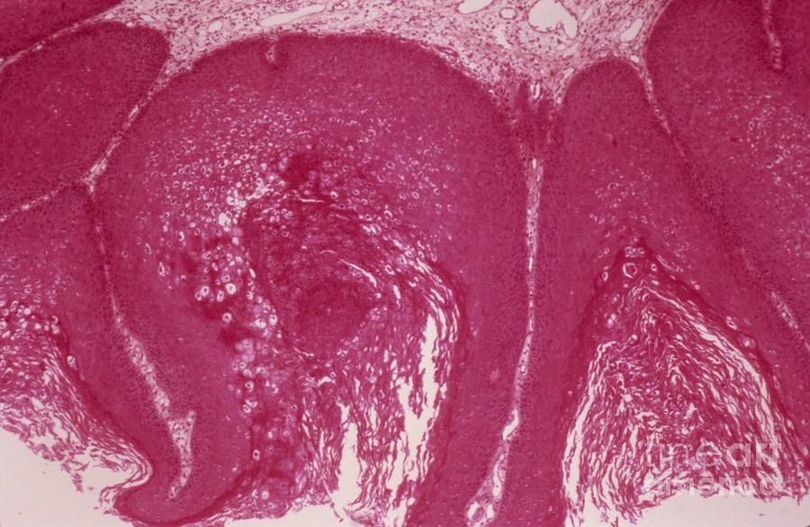 Cervical Wart, Light Micrograph by Science Photo Library