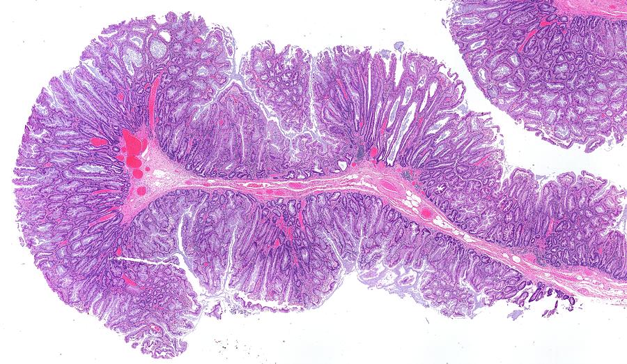 Colon Polyp Photograph by Microscape - Pixels