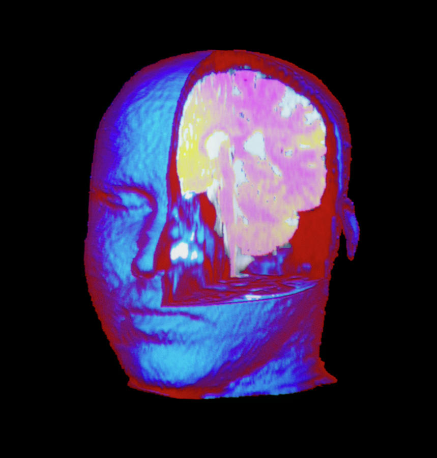 Coloured 3-d Mri Scan Of Human Brain In The Head Photograph by Garry Watson/science Photo ...
