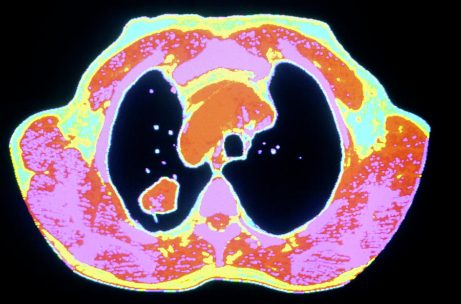 Coloured Computed Tomography Scan Of Lung Cancer by Science Photo Library