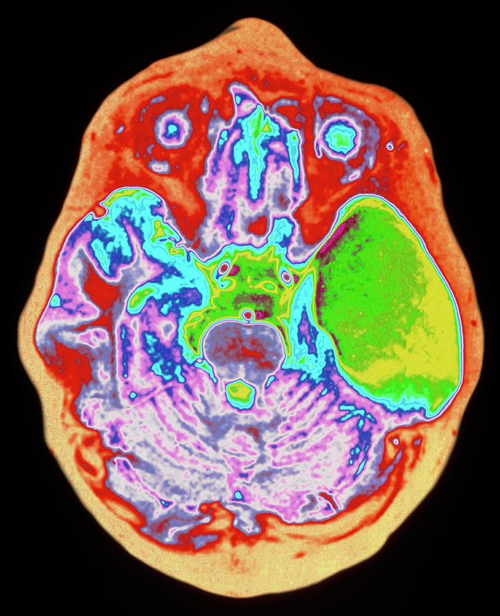 Coloured Mri Brain Scan Showing An Arachnoid Cyst by Mehau Kulyk/science Photo Library