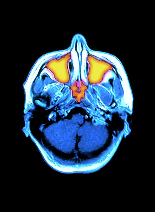 Coloured Mri Scan Of A Person's Head & Sinuses Photograph by Alfred Pasieka/science Photo Library