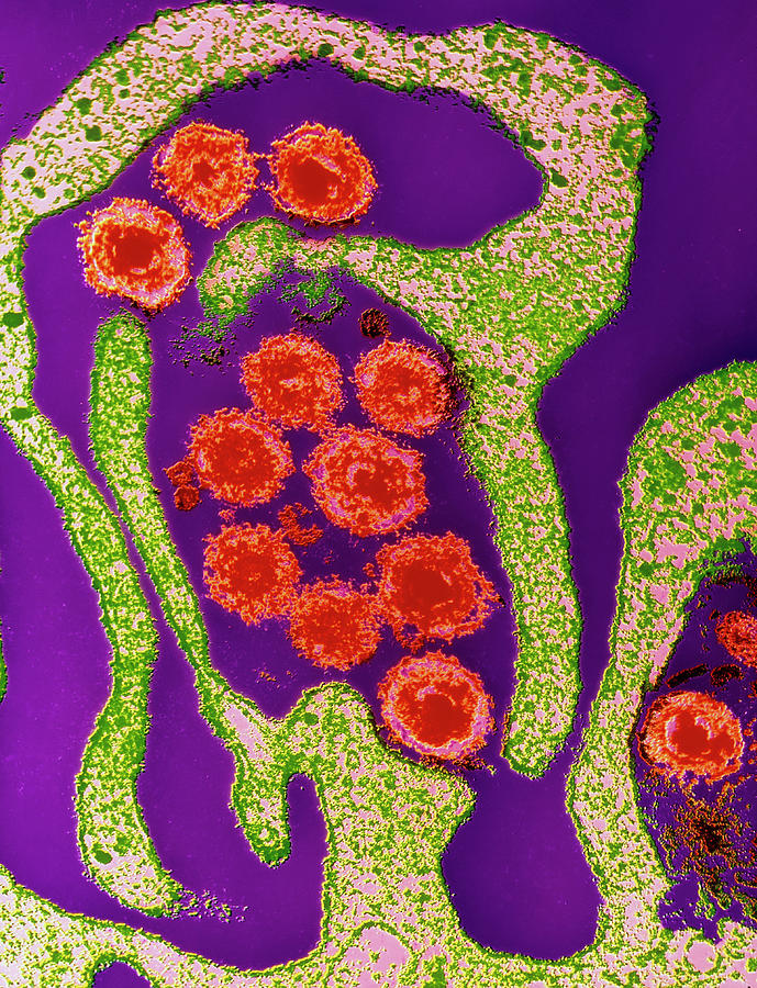 Coloured Tem Of Hhv6 Infecting A Cell Photograph by A.b. Dowsett/science Photo Library - Pixels