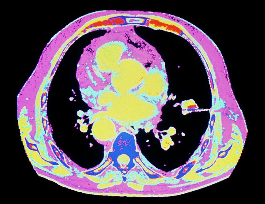 Computed Tomography Scan Of Lung Cancer Biopsy by Science Photo Library